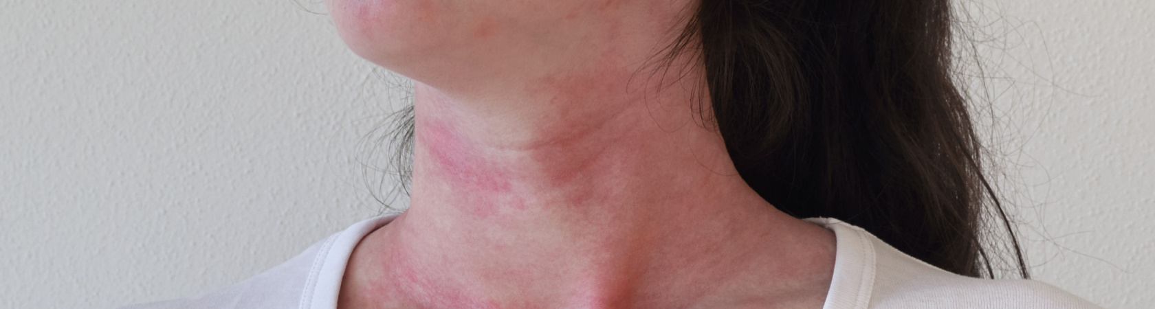 Alcohol Allergies: An Allergic Reaction to Alcohol